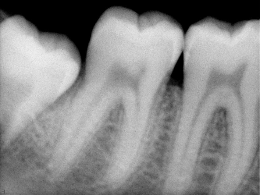 Sensor Radiológico Digital odontológico TIMEX 2H - Gnatus