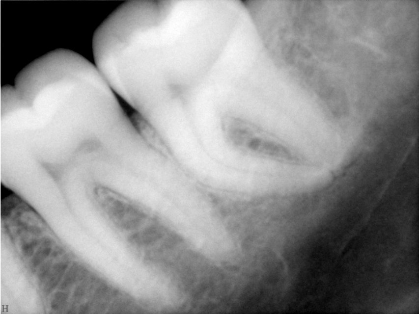 Sensor Radiológico Digital odontológico TIMEX 2H - Gnatus