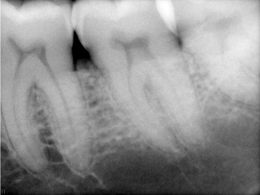 Sensor Radiológico Digital odontológico TIMEX 2H - Gnatus